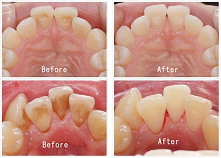 クリーニング（PMTC) | 治療の内容 | 新宮湊歯科クリニック 新宮町の歯医者